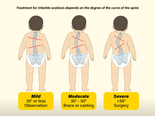 Exploring The Scoliosis Degrees Of Curvature Chart Exploring The Scoliosis Degrees Of Curvature Chart